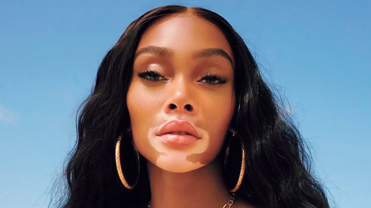 Winnie Harlow Age, Height, Affairs, Net Worth, Husband, Kids And More » Biography Wallah